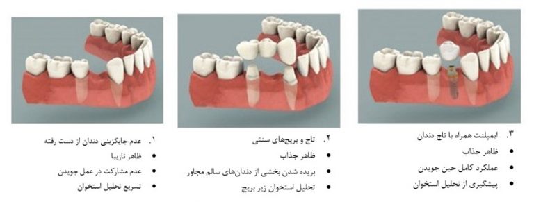 آبسه دندان و تحلیل رفتن استخوان لثه دكتر سهیل آذرخش متخصص عصب کشی و