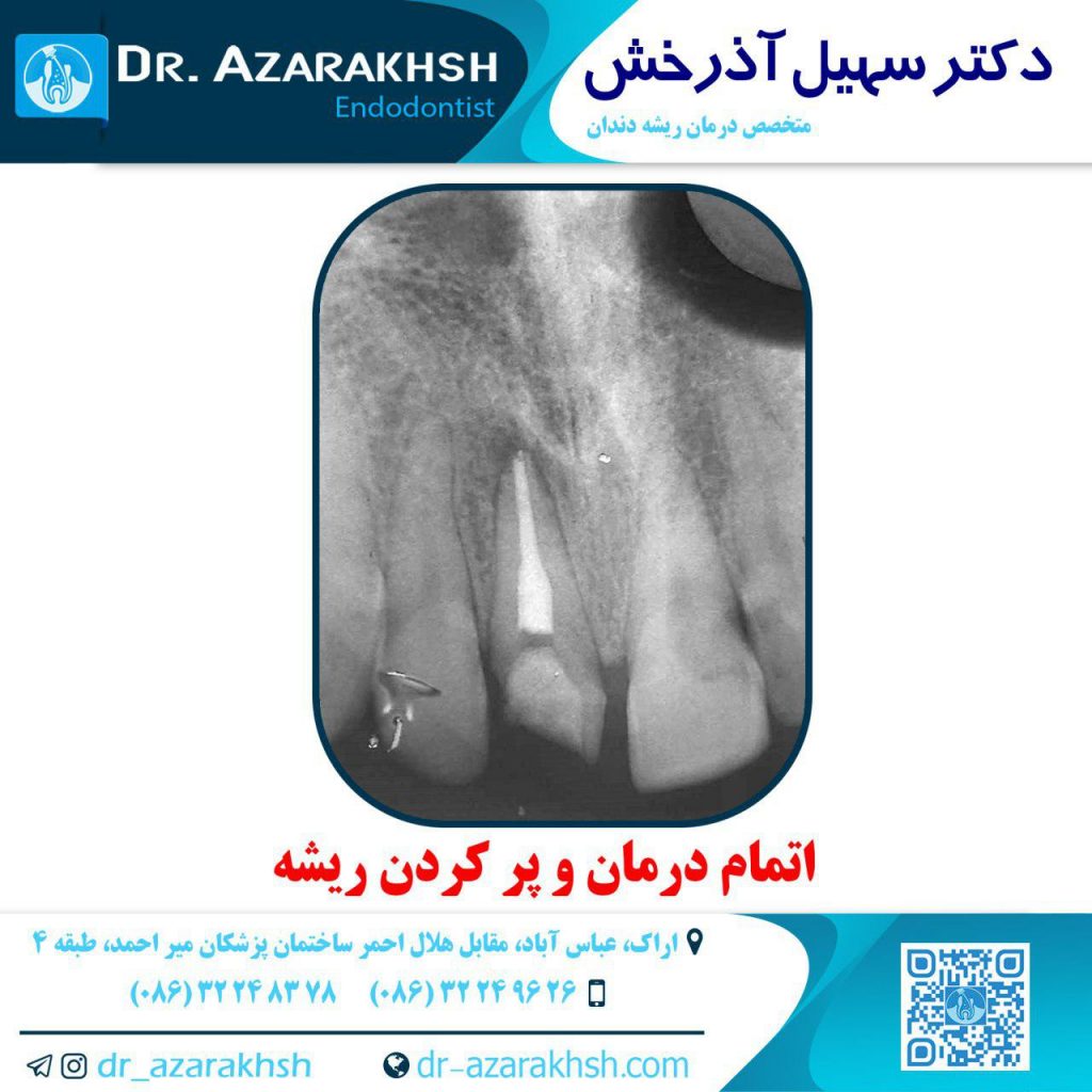 خارج کردن گوتا دکتر سهیل آذرخش جراح و متخصص درمان ریشه در شهر اراک